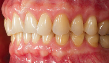 Minimal Invasive Prosthetic Procedures (MIPP) in Full Mouth Rehabilitation