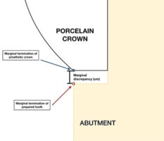 Marginal Gaps of Porcelain Crowns by Manufacturing Technique: A ...