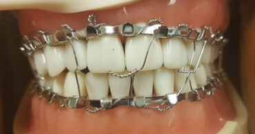 Orthognathic Surgery with Clear Aligner Therapy - Oral Health Group