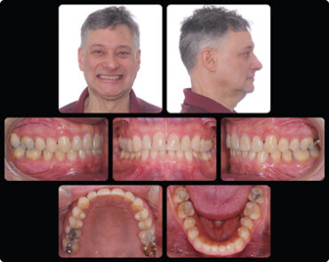 Facially Driven Treatment Planning to Manage the Adult Patient with ...