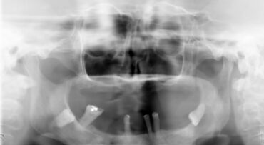 Malignant Transformation of an Odontogenic Cyst: Report of Two Cases