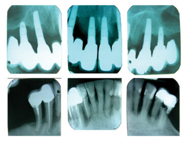 Rehabilitation of Both Failing Implants and Remaining Dentition with ...