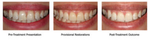 Provisional Restorations in Fixed Prosthodontics: An Essential Step for ...