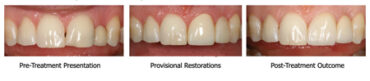 Provisional Restorations in Fixed Prosthodontics: An Essential Step for ...
