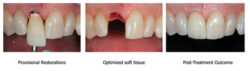 Provisional Restorations in Fixed Prosthodontics: An Essential Step for ...