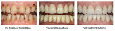 Provisional Restorations in Fixed Prosthodontics: An Essential Step for ...