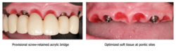 Provisional Restorations in Fixed Prosthodontics: An Essential Step for ...