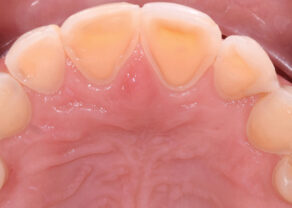 An Overview on Dental Wear - Oral Health Group