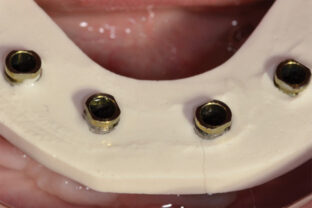 Alternative Verification Jig for the Assessment of Mandibular Flexure