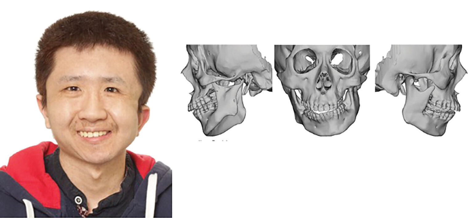 Managing Hemifacial Microsomia with Total Custom TMJ Replacement