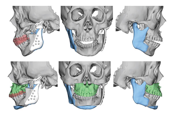 Managing Hemifacial Microsomia with Total Custom TMJ Replacement