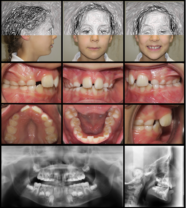 Interceptive Treatment for Patients with Maxillary Dysplasia