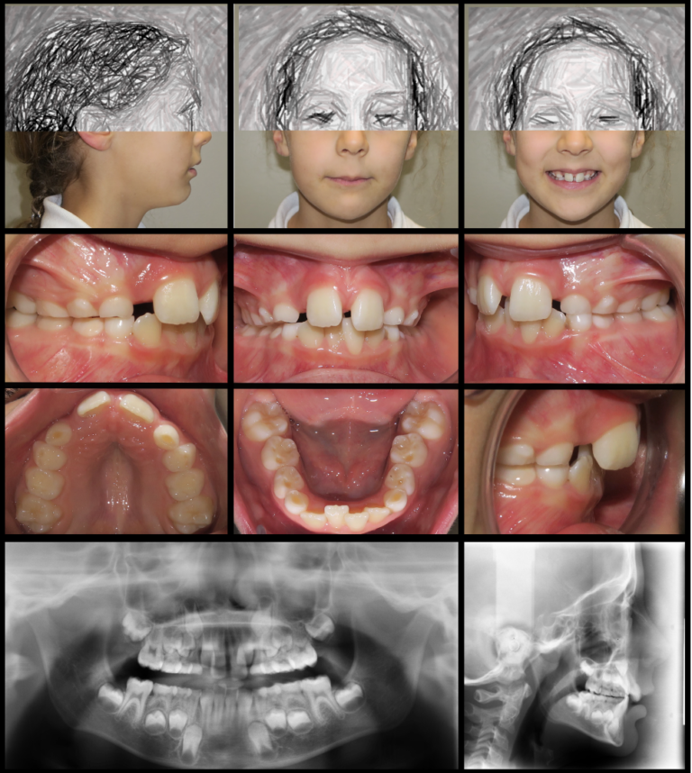 Interceptive Treatment for Patients with Maxillary Dysplasia