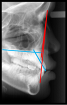 Interceptive Treatment for Patients with Maxillary Dysplasia