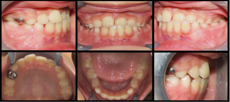 Interceptive Treatment for Patients with Maxillary Dysplasia