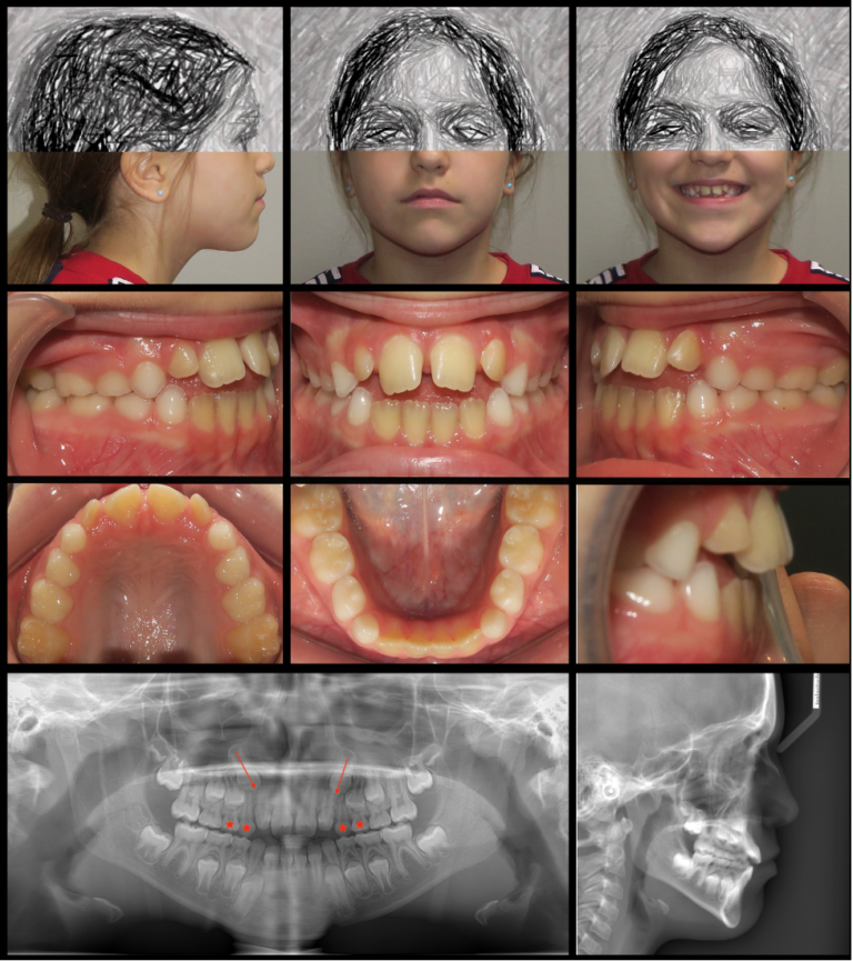 Interceptive Treatment for Patients with Maxillary Dysplasia