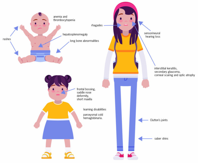 Green Teeth? The Many Shades of Congenital Syphilis - Oral Health Group