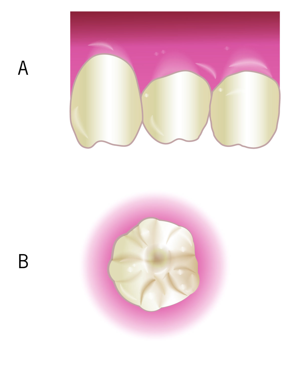 Green Teeth? The Many Shades of Congenital Syphilis - Oral Health Group