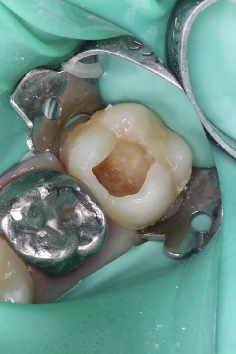 Smart Dentistry for the Kids in Your Practice - Silver Modified ...