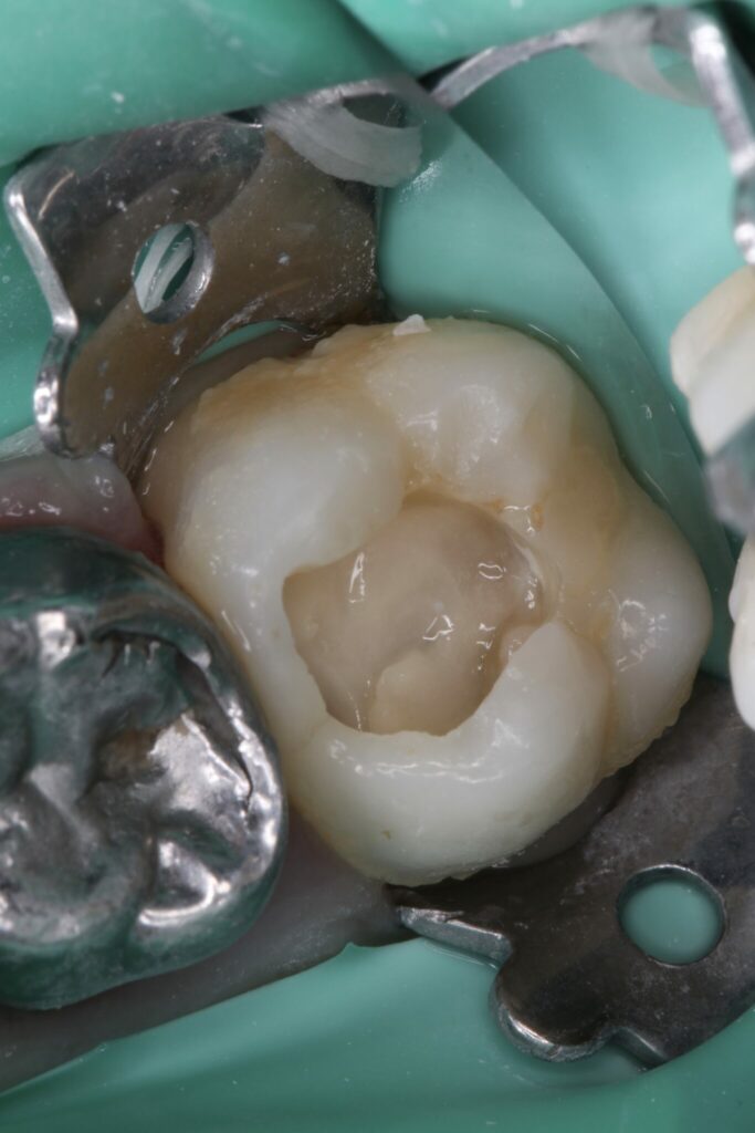 Smart Dentistry for the Kids in Your Practice - Silver Modified ...