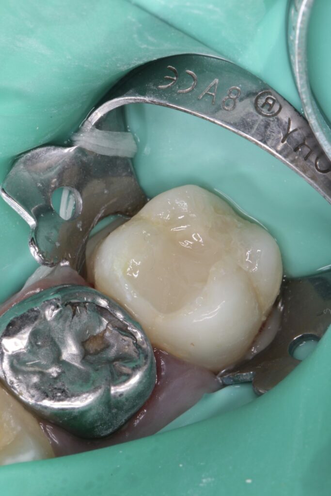 Smart Dentistry for the Kids in Your Practice - Silver Modified ...