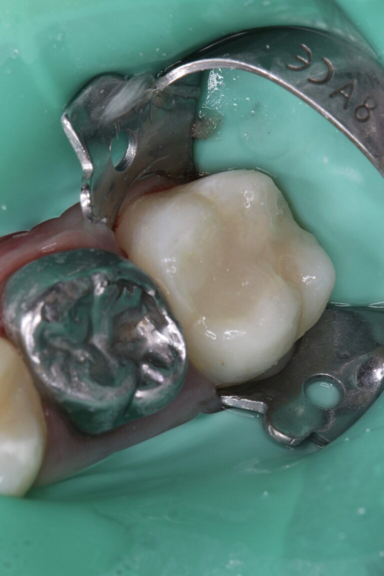 Smart Dentistry for the Kids in Your Practice - Silver Modified ...