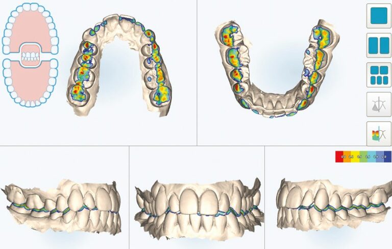 iTero Element® Scanner Digital Applications for Comprehensive Dentistry ...