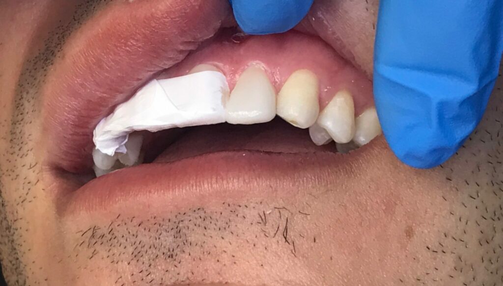 Minimally Invasive Cosmetic Dentistry: Simple Techniques to Improve ...