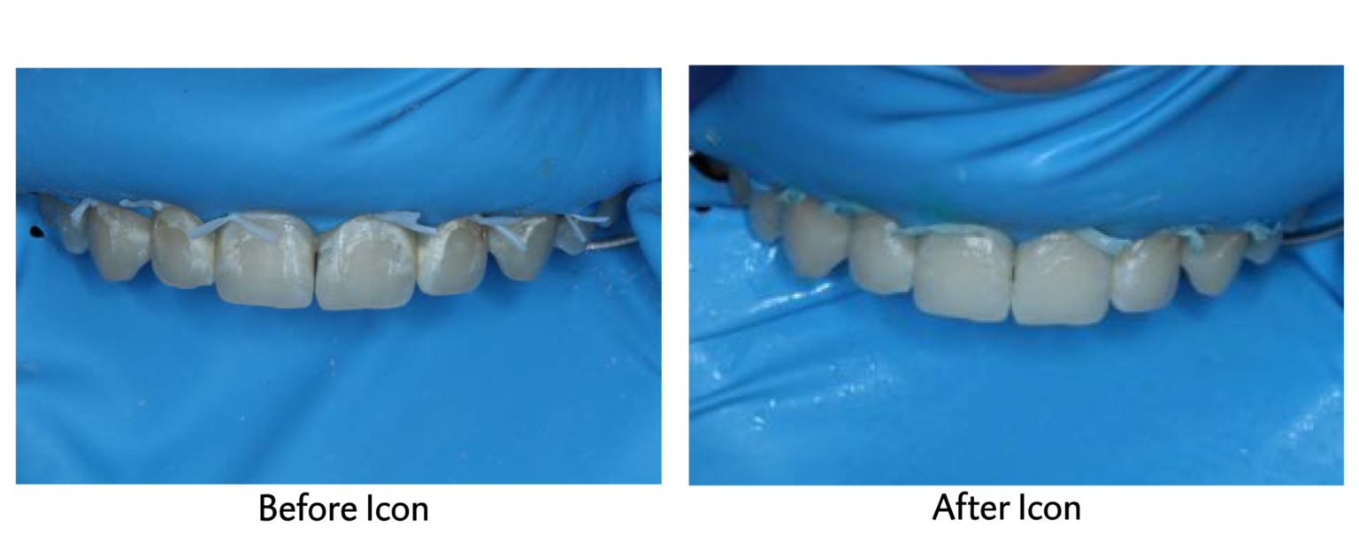Resin Infiltration: Revolutionizing the Way We Treat Early Caries ...