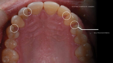 Management of Multiple Diastemas with Indirect Restorations