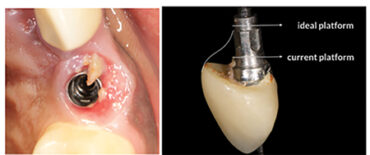Simplifying Anterior Restorations in Aesthetic Implant Dentistry
