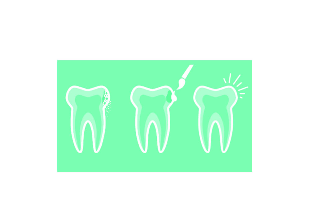 Just Say No To Drilling Early Proximal Caries And Say Yes To Resin Infiltration Oral Health Group