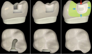 Armamentarium and Techniques For the Immediate Restoration of ...