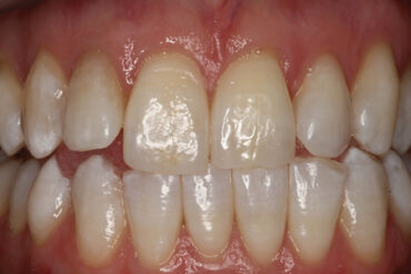 Esthetic Gingival Restoration - Oral Health Group