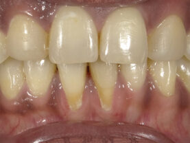 Esthetic Gingival Restoration - Oral Health Group