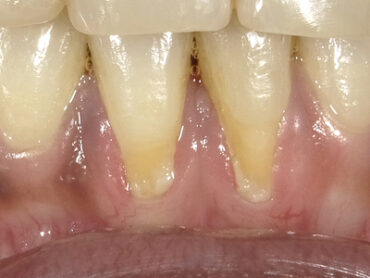 Esthetic Gingival Restoration - Oral Health Group