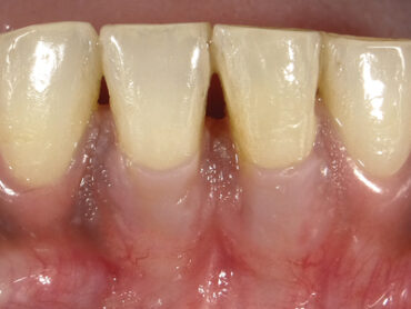 Esthetic Gingival Restoration - Oral Health Group