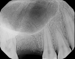 Osseodensification for Implant Dentistry: Multiple Clinical Applications