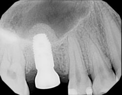 Osseodensification for Implant Dentistry: Multiple Clinical Applications