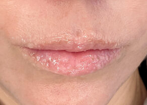 Lips: The Forgotten Oral Tissue - Oral Health Group