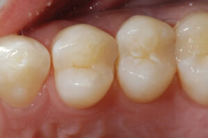 Flowable Composite Class II Restorations - Oral Health Group