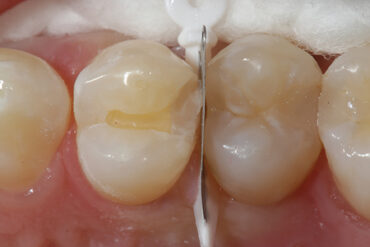 Flowable Composite Class II Restorations - Oral Health Group