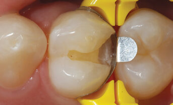 Flowable Composite Class II Restorations - Oral Health Group