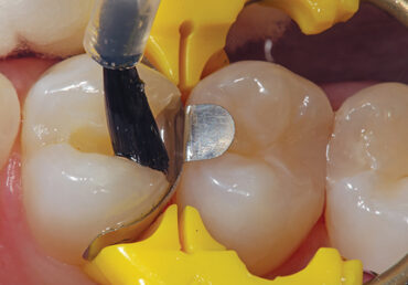 Flowable Composite Class II Restorations - Oral Health Group