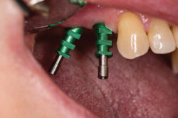 Angulated Implant Placement in the Posterior Maxilla to Avoid Sinus ...