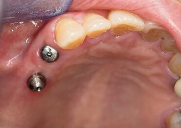 Angulated Implant Placement in the Posterior Maxilla to Avoid Sinus ...