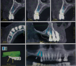 Angulated Implant Placement in the Posterior Maxilla to Avoid Sinus ...