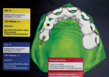 Angulated Implant Placement in the Posterior Maxilla to Avoid Sinus ...