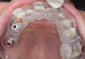 Angulated Implant Placement in the Posterior Maxilla to Avoid Sinus ...