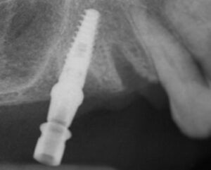 Angulated Implant Placement in the Posterior Maxilla to Avoid Sinus ...